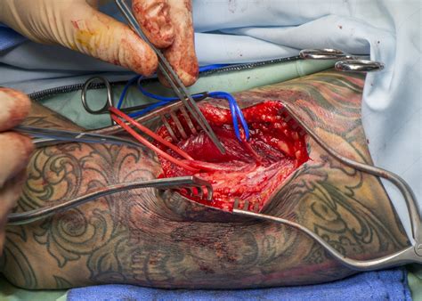 Radial Nerve Decompression In The Upper Arm Surgical Technique Orthoracle