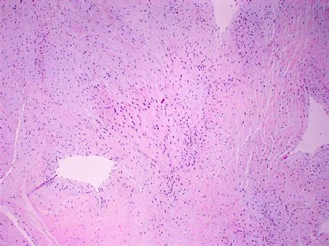 Heart Valve Histology At Chad Thornton Blog