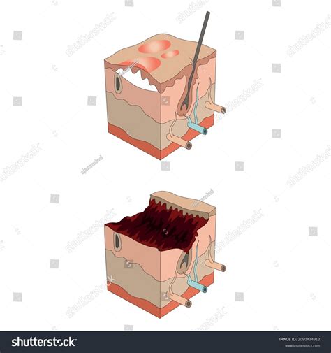 Illustration Of Burn Depth
