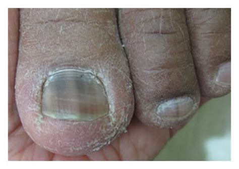 Melanonychia Jefferson 2012 Dermatology Research And Practice