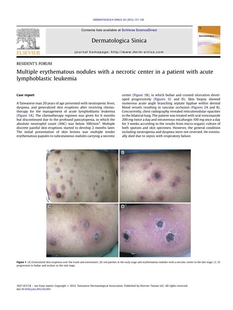 [pdf] Multiple Erythematous Nodules With A Necrotic Center In A Patient