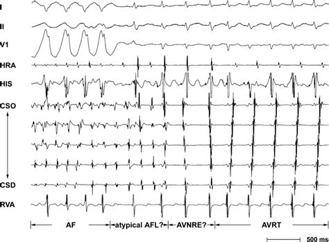 Tracing Showed Atrial Fibrillation Af With Accessory Pathway