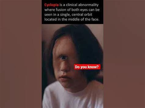 What Is Cyclopia A Single Eye Facts Medical Genetics Shorts Youtube