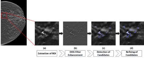 Microcalcification Cluster Segmentation Process Demonstration On A