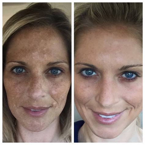 Chemical Peel Before After Artofit