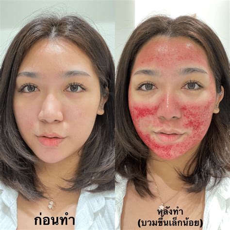 รวมรวว Pico Laser รกษาหลมสว รอยสว รอยดำ ท THE RITZ CLINIC