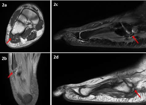Mri Of The Right Foot Axial T1 Non Fat Saturation 2a Coronal Fluid