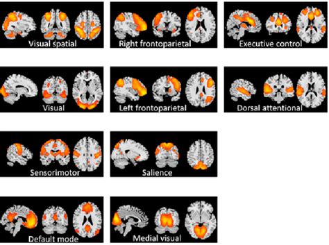 Figure 2 From Functional Connectivity Patterns In Parosmia Semantic