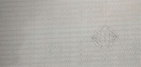 Diffuse Proliferative Cerebral Angiopathy A Case Report And Literature Review On A Very Rare