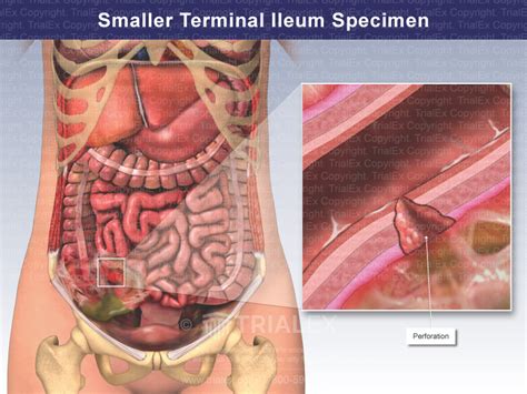 Smaller Terminal Ileum Specimen Trialquest Inc