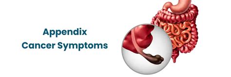 አባሪ የካንሰር ምልክቶች፡ የሚያስፈልግዎ አስፈላጊ መረጃ