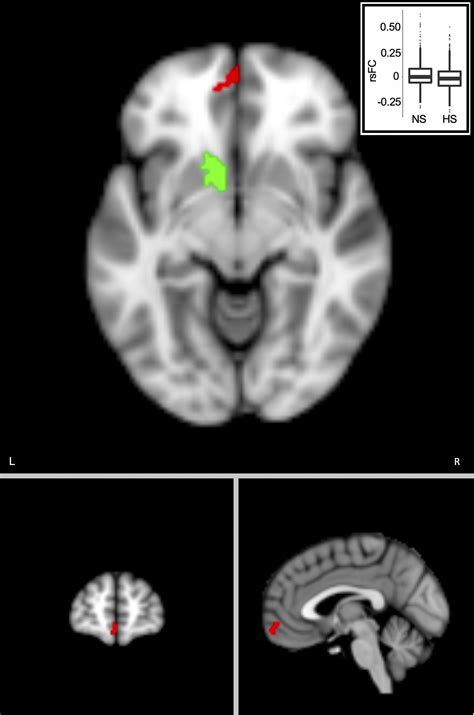 Reciprocal Relationships Between Stress And Depressive Symptoms The