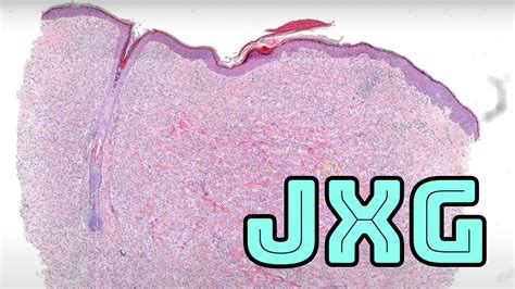 Jxg Juvenile Xanthogranuloma Solitary Xanthogranuloma Foamy Cells