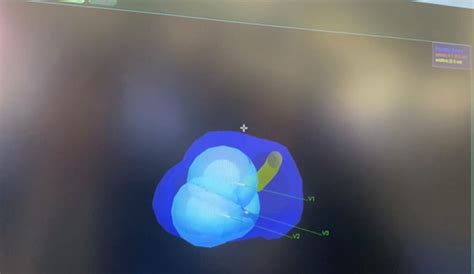 What Is Cryotherapy For Prostate Cancer