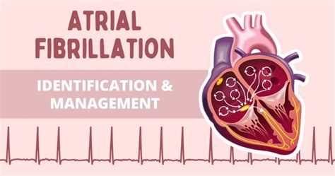 Afib Rvr On Ekg Management Of Atrial Fibrillation Health And Willness