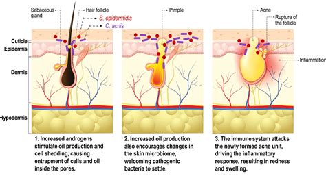 Are Hormones To Blame For My Acne Zrt Laboratory