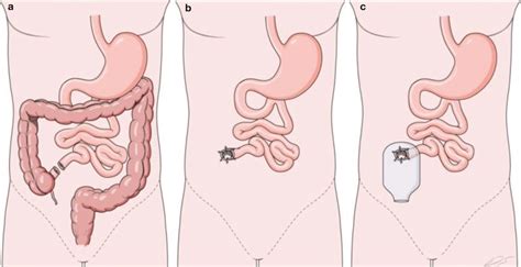 Ostomy 101 What Is Panproctocolectomybarbie Butt Surgery The