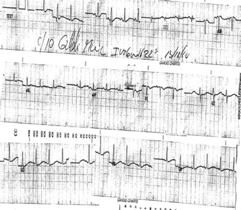 Corrected QT Interval On Admittance Seconds Download Scientific Diagram