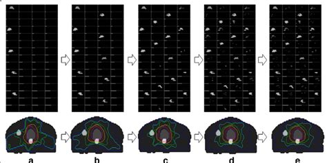 The Segments And Dose Distributions Of Vmat Plans For Five Beam Sets Download Scientific