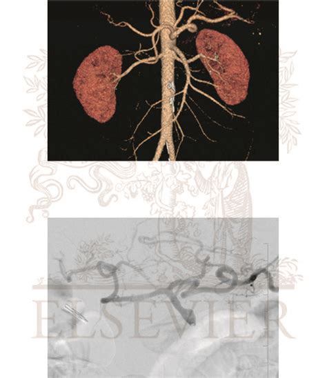 Celiac Arteriogram And Ct Angiogram
