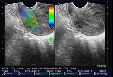 Cervical Elastic Ultrasound Download Scientific Diagram