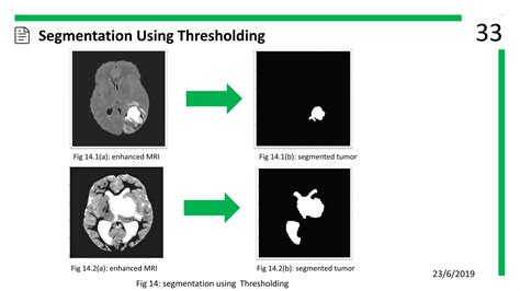 Brain Tumor Detection Using Convolutional Neural Network Pptx Brain And Nervous System