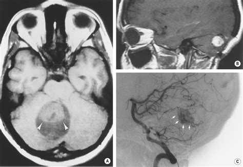 Intracranial Tumours Clinical Tree