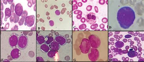 Acute Myeloid Leukemia With Specific Gene Mutations