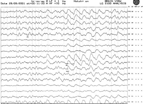 Eeg Showing Intermittent Delta Activity And Triphasic Waves Download
