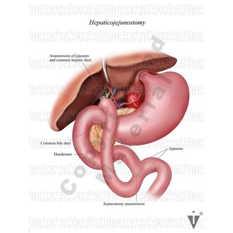 Stock Gallbladder Hepaticojejunostomy — Illustrated Verdict
