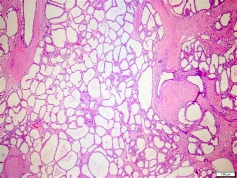 Pathology Outlines Serous Cystadenoma