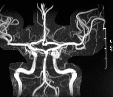 Circle Of Willis Mri Radiology Edu On Twitter Neck Mra Anatomy