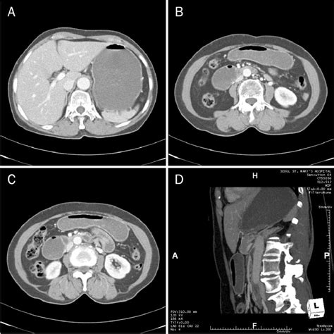 Abdominal Ct Scan Reveals Marked Distension Of Stomach And Duodenum A