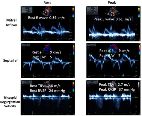 Diastolic Stress Test Invasive And Noninvasive Testing