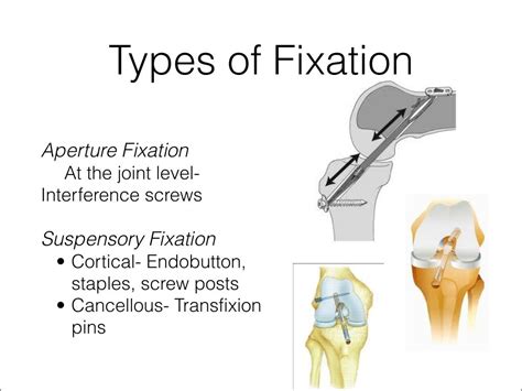 Acl Graft Fixation Options Acl Graft Fixation Options
