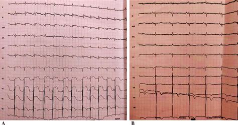 A Electrocardiogram After Ventricular Tachycardia Reducing Showing
