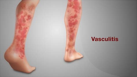 Ayurvedic Treatment Of Vasculitis Neuropathy Herbal Remedies