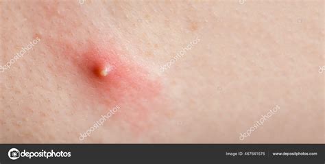 Pimple Pus