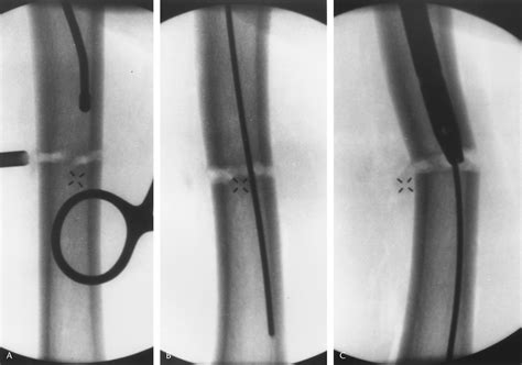 Diaphyseal Derotational Osteotomy With Intramedullary Fixati