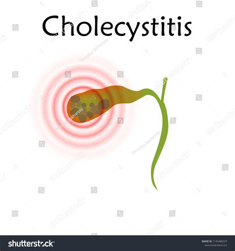 Gallbladder Disease Inflammation Gallstones Cholecystitis Anatomy