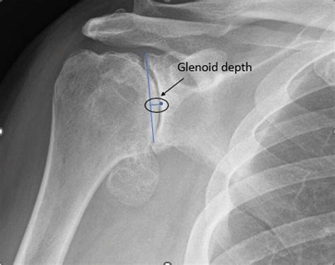 Glenoid Depth Was Measured As The Distance Between The Center Of The Download Scientific
