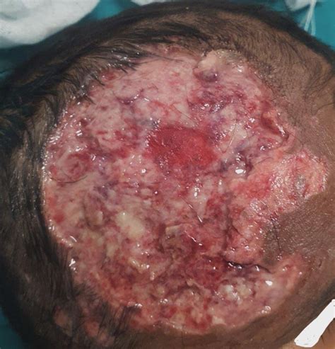 Early Pyoderma Gangrenosum Powerpoint