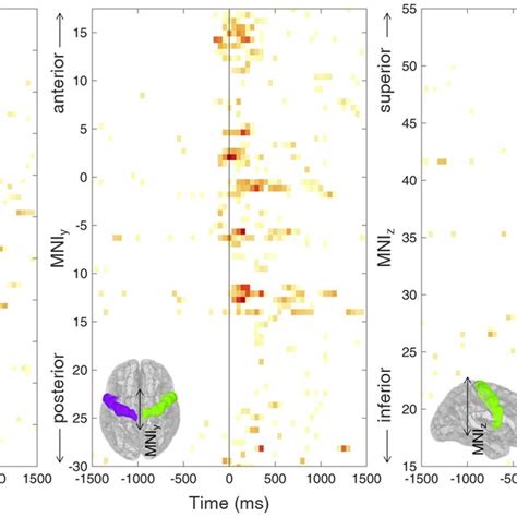 Time Resolved Normalized Decoding Accuracy In The Precentral Gyrus In