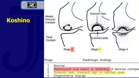 Knee Osteonecrosis Ppt
