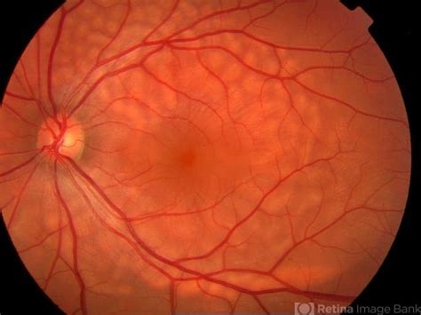Acute Exudative Polymorphous Vitelliform Maculopathy Color Os Retina Image Bank
