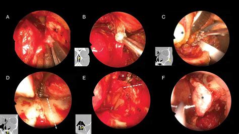 How To Endoscopic Total Maxillectomy Without Facial Skin Incision