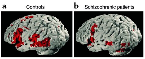 Schizophrenia Brain Mri