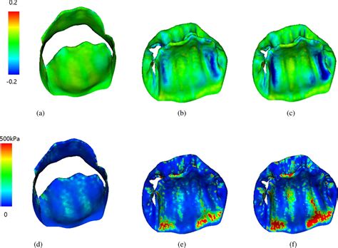 Effects Of Different Constitutive Laws On Fluid Structure Interaction Fsi Simulation Of The