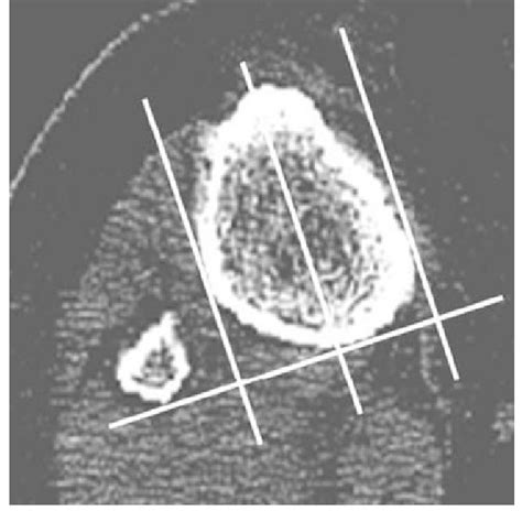 An Axial View Of The Proximal Tibia And Fibula At Slice 5 With The