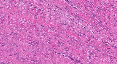 Tumor Desmoide Mypathologyreport